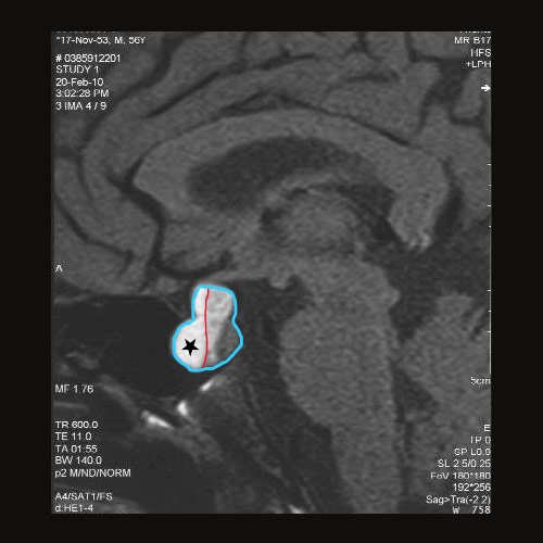 Apoplexia Hipofisária - Tratamentos e Cirurgias com Dr. Gilberto Ochman